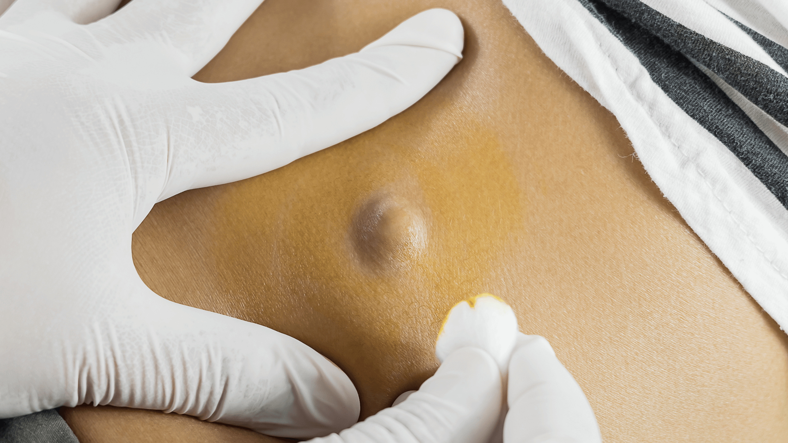 Why Do Painful Skin Cysts Occur? A Comprehensive Guide for Bedford, TX ...